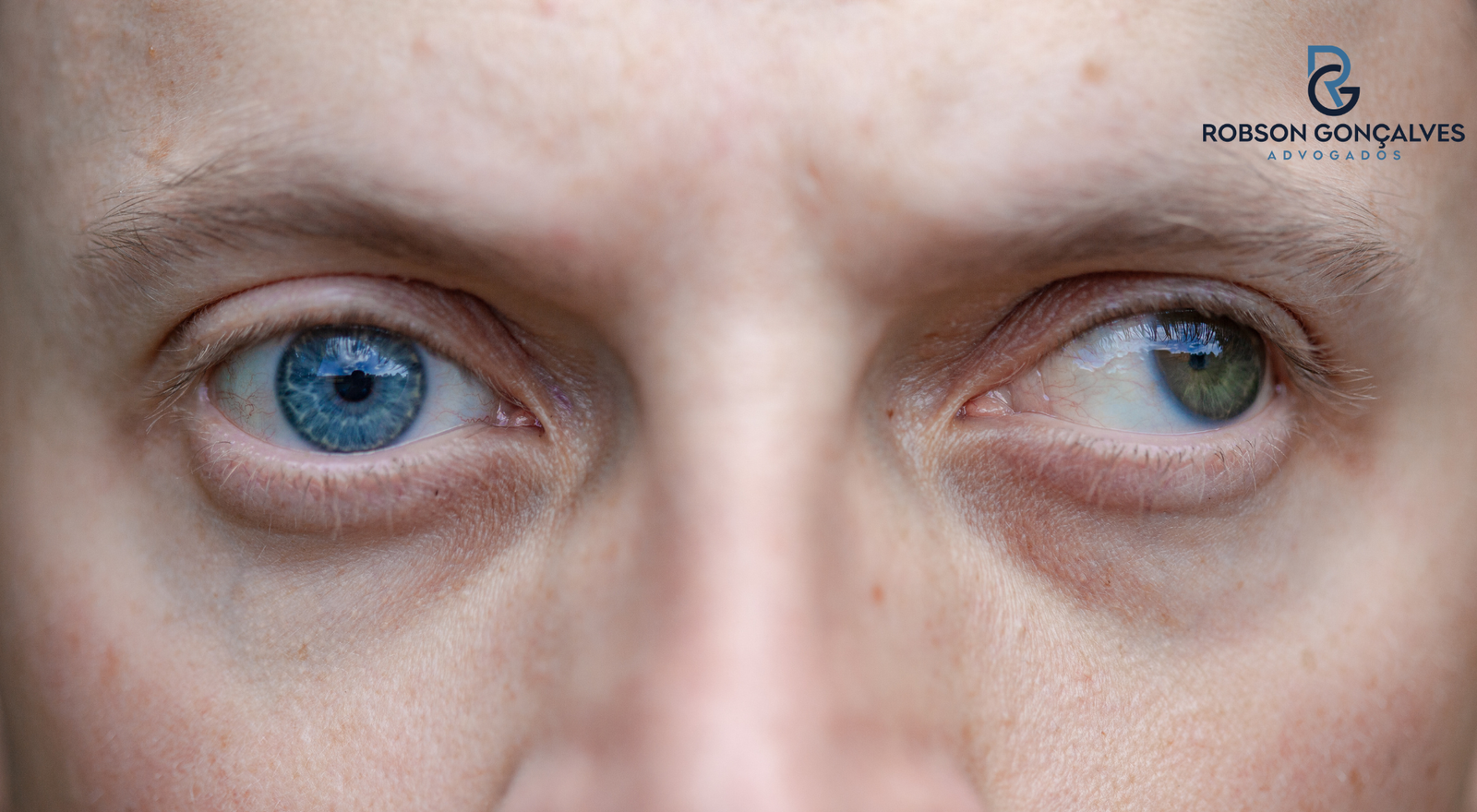 Visão Monocular: CID H54.4 pode receber o BPC/LOAS!